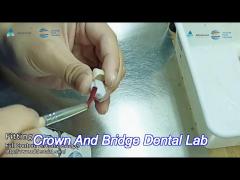 Corone di zirconia naturale a contorno completo, corrispondente al laboratorio dentale a contorno completo