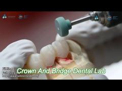 Ponte Dental Durabile Ponte EMAX ipoallergenico Estetica estrema Ponte Dental Emax