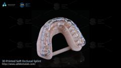 Custom 3D Printed Splint for Bruxism Comfort