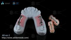 Premium Titanium Implant Bar for All On X Dentistry