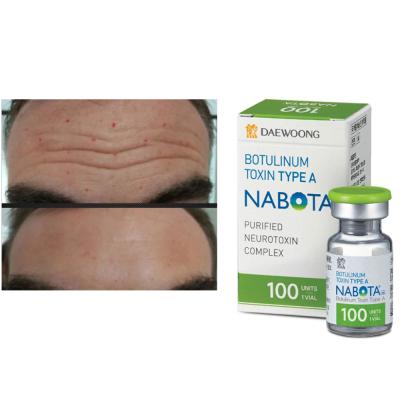 China Bocouture Meditoxin Botulinumtoxin 100u for Anti Wrinkles Botulax 200units Nabota for sale