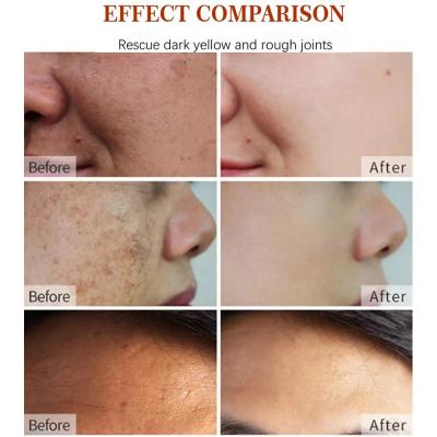 China Face Black Freckle Acne Fade Dark Spot Removing Corrector Whitening Cream for sale