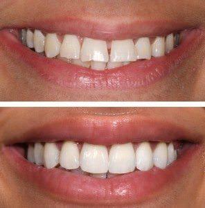 China Yucera 5-Axis Dental Cad Cam Milling Machine Wet for Lithium Disilicate Cad Cam Block for sale