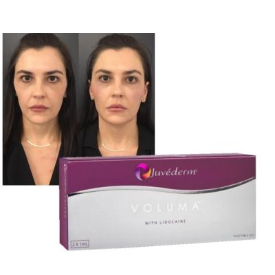 China Juvederm Hyaluronic Acid Dermal Filler Gel for Lips and Cheeks for sale