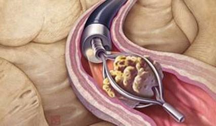 Disposable Endoscopic Stone Retrieval basket for foreign body removing