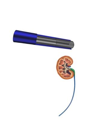 China Smart Urethral Access Sheath Bluetooth Alerts 35cm Length With Pressure Monitoring for sale