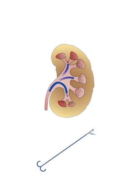 Quality High Value Ureteral Access Sheath Endourology Practices Access Sheath Urology for sale