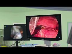 Watch: Disposable Cholangioscope Endoscope Smart Suction For Safe Biliary Procedures Showcase