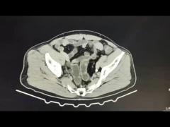 Facing Bilateral Complex Ureteral Stenosis: A 54-Year-Old Male's Clinical Journey