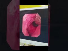 Antegrade Ureteral Stent Placement | Under Direct Vision