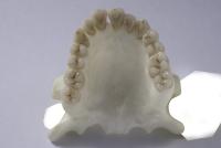 Quality Precise Bar Implant Supported Hybrid Denture Comfortable Fit Replace Missing for sale