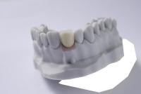 Quality Customized Bar Retained Implant Overdenture Over Implant Bar With Preci for sale