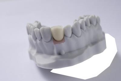 China Customized Bar Retained Implant Overdenture Over Implant Bar With Preci Attachments for sale