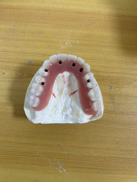 Quality Customized Long Lasting Implant Retained Dentures For Dental Prosthetics for sale