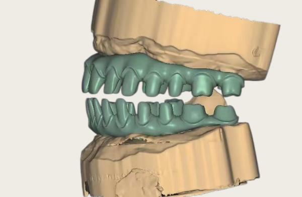 Quality Bonded Wire Orthodontic Retainer Permanent CAD CAM Fabrication For Teeth for sale