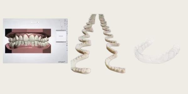Quality Screw Retained Implant Crowns And Bridges High Esthetic Dental Restorations for sale