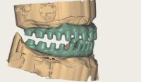 Quality Bonded Wire Orthodontic Retainer Permanent CAD CAM Fabrication For Teeth for sale