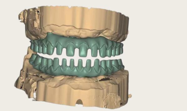Quality Bonded Wire Orthodontic Retainer Permanent CAD CAM Fabrication For Teeth for sale