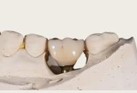 Quality Screw Retained Dental Implant Crowns PFZ Porcelain Layered Dental Zirconia Crown for sale