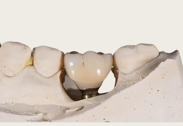 Quality Screw Retained Dental Implant Crowns PFZ Porcelain Layered Dental Zirconia Crown for sale