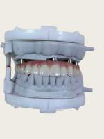 Quality High Accuracy Dental Implant Crown And Bridge For Natural Tooth Contour for sale