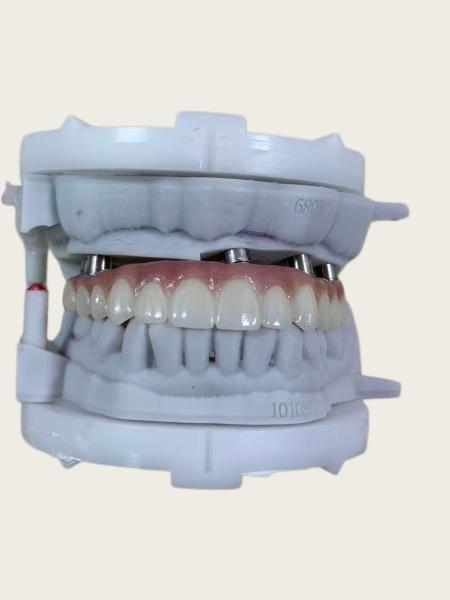 Quality High Accuracy Dental Implant Crown And Bridge For Natural Tooth Contour Enhancing for sale