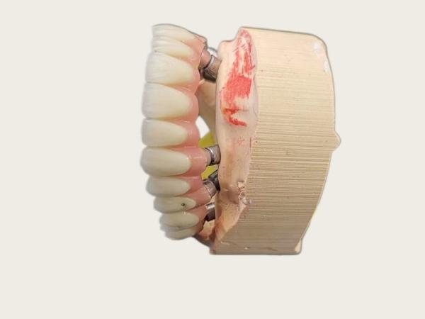Quality Dental Implant Metal Ceramic Bridges Titanium Abutments CAD CAM High Precision for sale