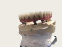 Quality Full Zirconia Bridge With Titanium Bar Support Full Arch Solutions Comfortable for sale