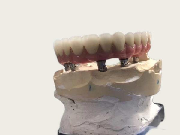 Quality Full Zirconia Bridge With Titanium Bar Support Full Arch Solutions Comfortable Fit for sale