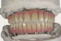 Quality Innovative Implant Hybrid Bridge Implant Supported Hybrid Bridge For Dental for sale