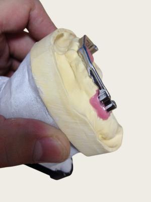 China CAD CAM Tooth Combination Dentures Secure Fit Easy Maintenance Partial Dentures for sale