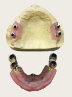China Accurate Combination Dentures Removable Partial Denture Natural Appearance for sale