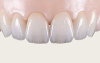 Quality Dental Full Mouth Zirconia Bridge High Translucency Precision Fit Staining for sale