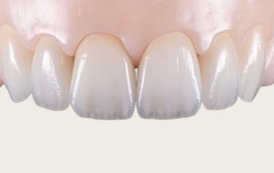 China Dental Full Mouth Zirconia Bridge High Translucency Precision Fit Staining Resistant for sale