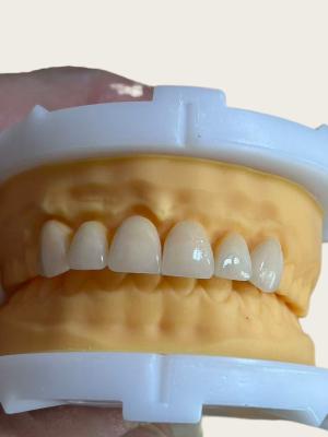 China Dental Lab Emax Laminate Veneers High Esthetic Teeth Veneers Natural Appearance for sale