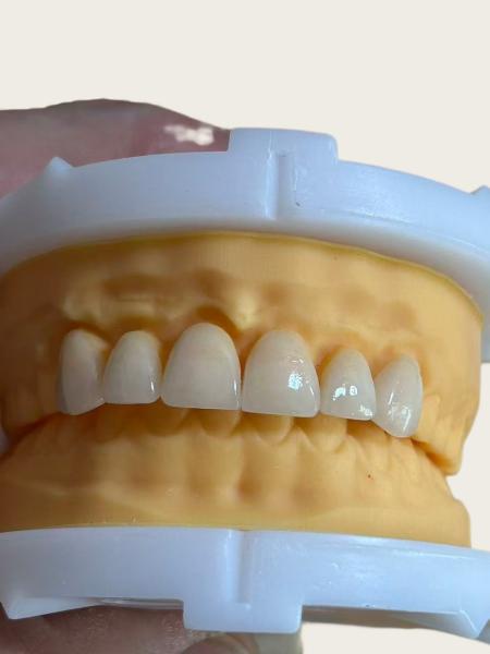 Quality Dental Lab Emax Laminate Veneers High Esthetic Teeth Veneers Natural Appearance for sale