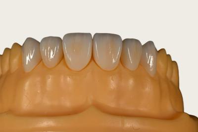 China Lightweight Dental Lab Laminate Veneers High Esthetic CAD CAM Veneers Custom Made for sale