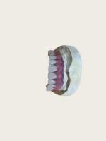 Quality High Precision Implant Supported Dentures Ivoclar Ball Attachments Natural for sale