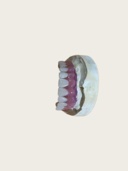Quality High Precision Implant Supported Dentures Ivoclar Ball Attachments Natural Appearance for sale