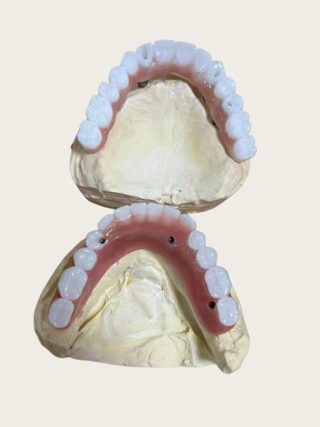 Quality Snap In Implant Supported Dentures Natural Looking Full Arch Implant Solutions for sale