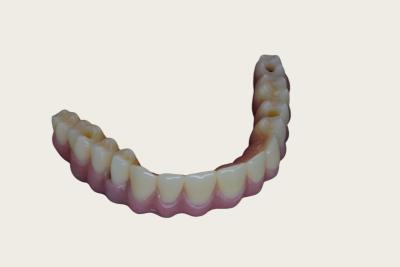 China Precise Dental Implant Supported Dentures Implant Locator Attachment Natural Looking for sale