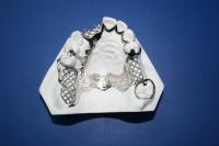 China Lightweight Titanium Dental Framework High Precision Partial Removable Dentures for sale