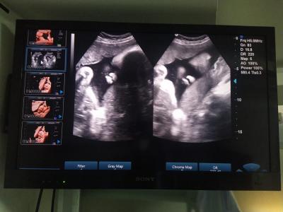 China Standard  Ultrasound Scanner Machine 21.5 Inch  High Definition Medical Te koop