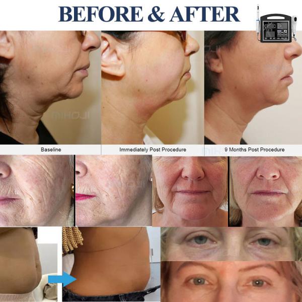 Quality Face Lift Anti Aging 5D HIFU Beauty Machine 2 In 1 High Intensity Focused for sale