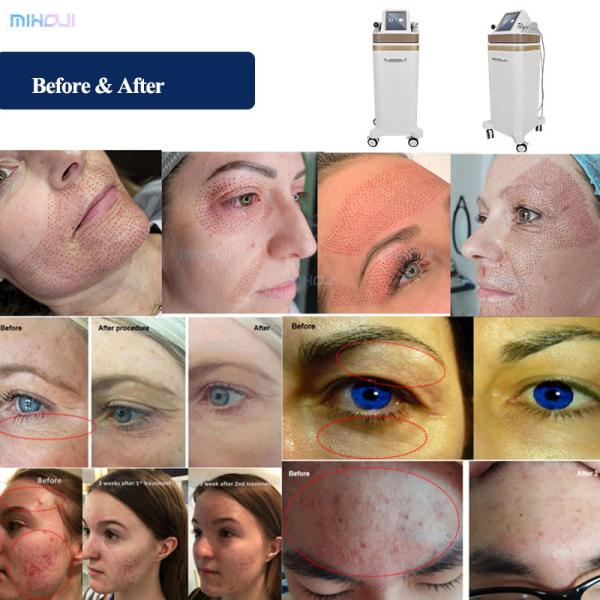 Quality Cold Plasma Facial Machine For High Precision And Portable 89W Power Supply for sale