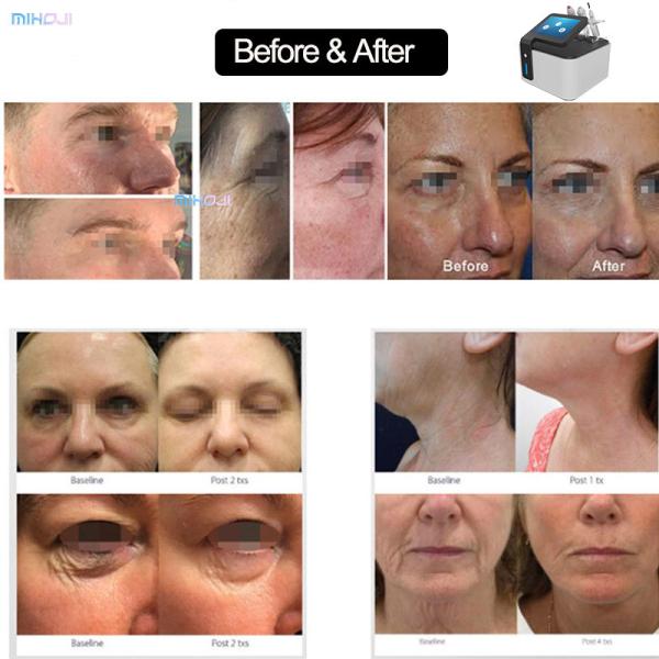 Quality Movable Plasma Facial Machine 3 In 1 For Skin Tightening And Whitening for sale