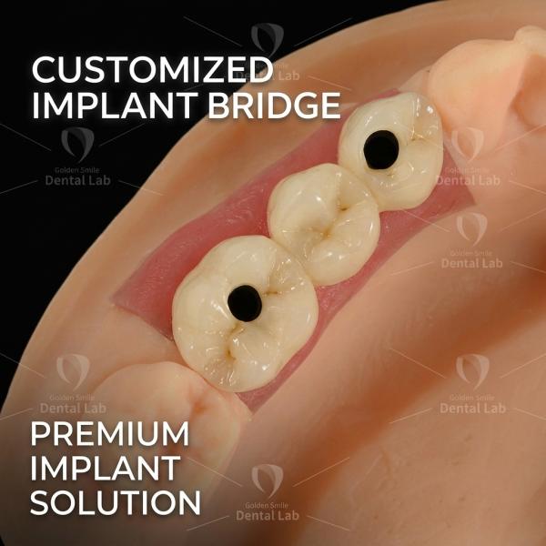 Quality Customizable Digital Dental Lab Services Dental Crown And Bridge Design for sale