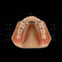 China Lightweight Cobalt Chrome Partial Denture Framework Clasp Flexible Acrylic Partial Denture for sale