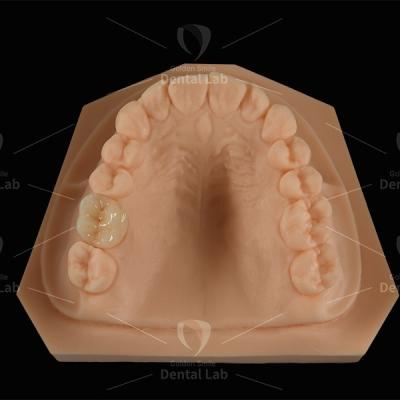 China E.Max Layered Crown 100% Metal Free Hand Layered Porcelain Overlay for sale
