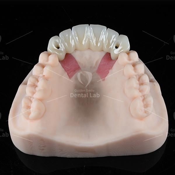 Quality Multilayered Full Zirconia Bridge Screw Retained Bridge Customizable for sale